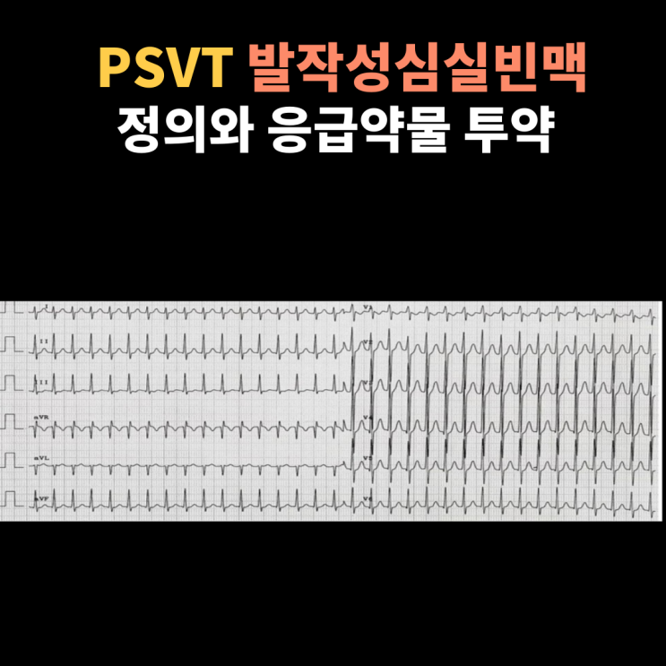 PSVT 심실성발작빈맥의 정의 및 실제상황 시 사용하는 약물에 대해 알아봐요~ : 네이버 블로그