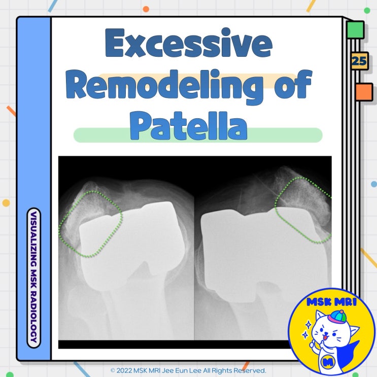 (Fig 5-D.25) Excessive Remodeling of Unresurfaced Patella After TKA ...