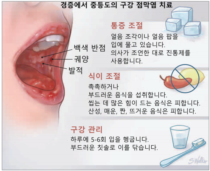 의학상식 암치료에 도움이 되는 의학상식 16 항암치료 중 발생할 수 있는 구내염점막염mucositis