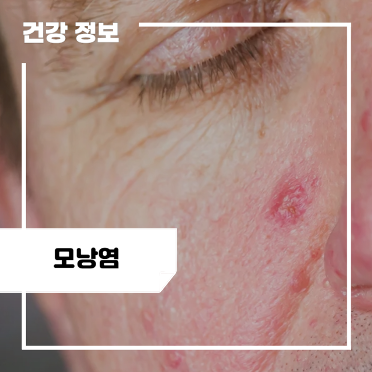얼굴 모낭염 증상 및 원인 치료 방법 기간 관리 약국 연고 두피 모낭염 증상 네이버 블로그