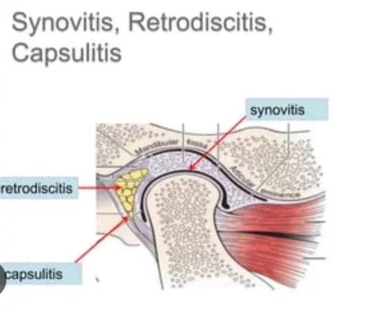 TMJ 염증성 장애 : 활막염(synovitis), 관절낭염(capsulitis) 정확한 위치 : 네이버 블로그
