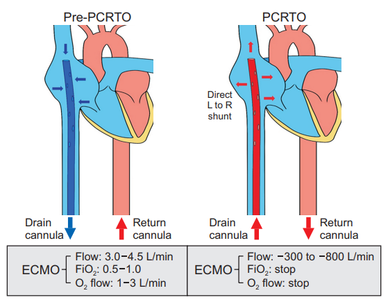 Pump-Controlled Retrograde Trial off for ECMO Weaning : 네이버 블로그