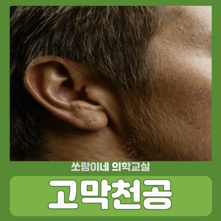 고막천공 수술 증상 치료 패치 네이버 블로그