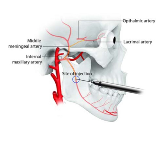 🦷치과 마취를 했는데 눈 앞이 안 보여요 : #48 Surgical Extraction with IAN nerve Block ...