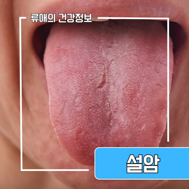 설암초기증상 및 원인 치료 혀암 문제 구강 입속 궤양 통증 네이버 블로그