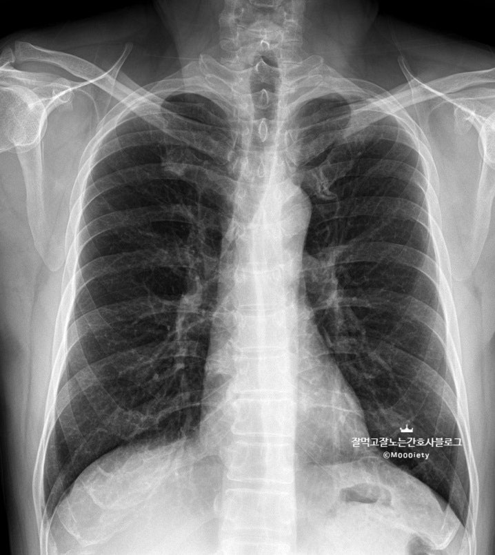 흉부X선 이해하기 : Chest PA/AP/ Chest PA/Lat & Chest Lat Decubitus & Chest ...