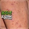 옴증상과 치료법 진드기물렸을때손가려움피부기생충 네이버 블로그