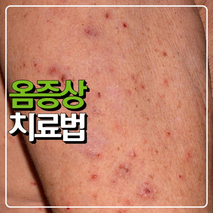 옴증상과 치료법 진드기물렸을때손가려움피부기생충 네이버 블로그