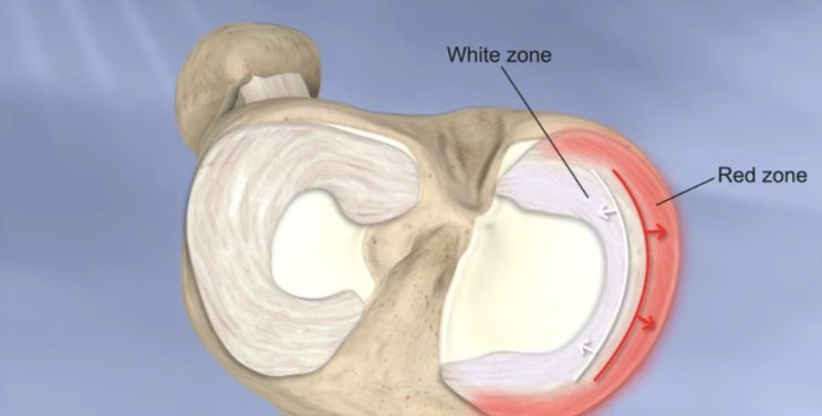 [정형외과] chondroplasty : 연골성형술 Meniscectomy : 반월판 제거술 / meniscus repair ...