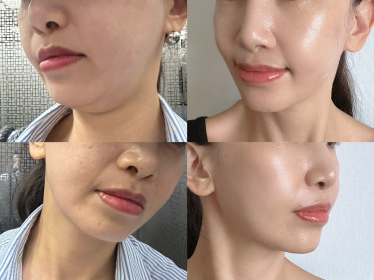써마지 FLX 600샷 가격 탄력 리프팅 시술 후기 : 네이버 블로그
