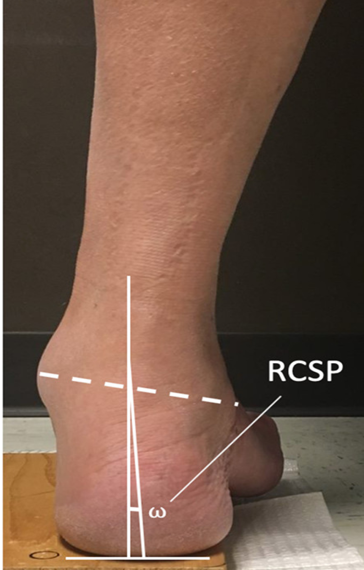 RCSP(Resting Calcaneal Stance Position) : 네이버 블로그