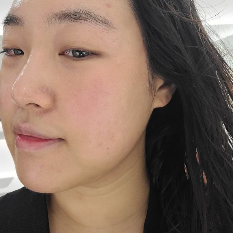 안아픈쥬베룩 무통스킨부스터 알아보고 NP쥬베룩으로 피부 좋아짐 : 네이버 블로그