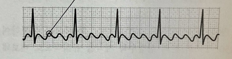 A-flutter : 심방조동, 의학용어 AF , Atrial Flutter, EKG 리듬, 원인 / 증상 / 치료방법 ...