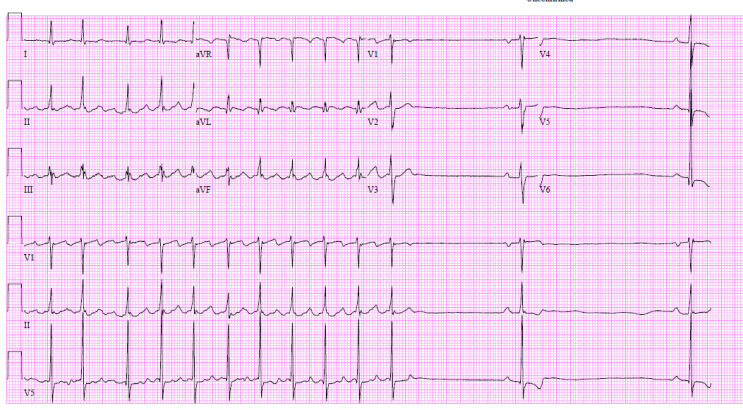 Sick Sinus Syndrome(SSS, 동기능 부전 증후군) : 네이버 블로그