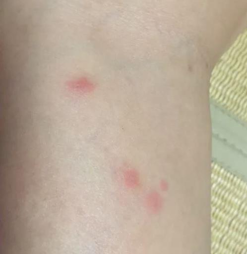 다리에 붉은반점 가려움 허벅지 종아리 빨간 두드러기 관리 후기 네이버 블로그