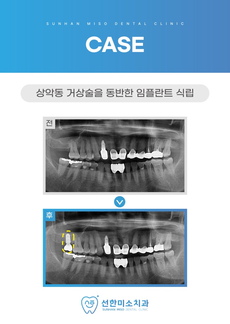 잇몸뼈가 부족해도 괜찮을까요 상악동 거상술을 동반한 임플란트 식립 사례 네이버 블로그