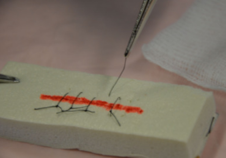 Intermittent suture removal(간헐적 봉합사 제거): stitch out : 네이버 블로그