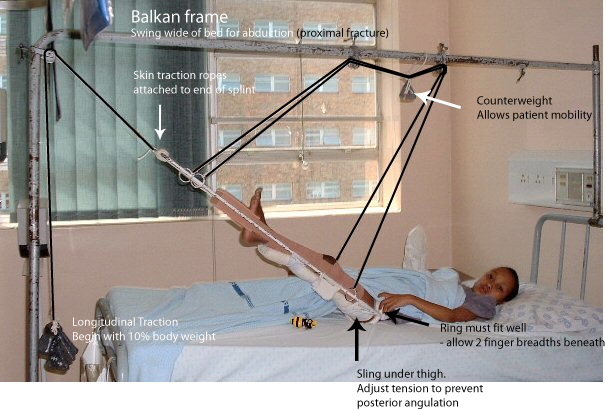 [Nclex 미국간호사 면허 독학] Hip Traction : 골반 고관절 골절(fracture) Buck's traction ...
