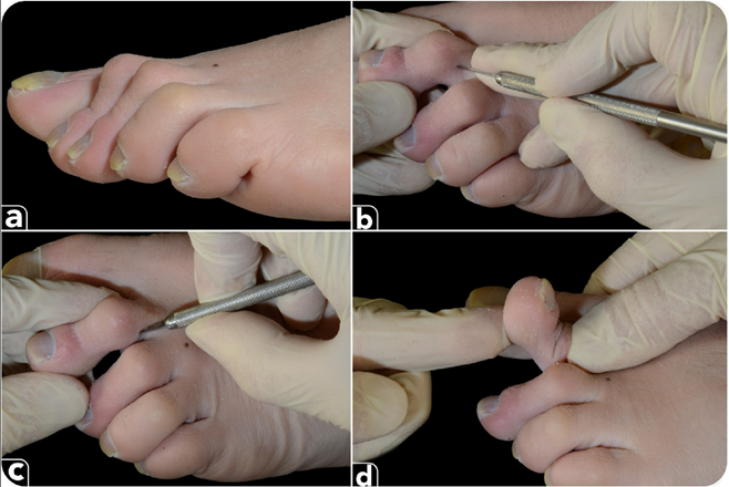 [정형외과 전문의] 발가락 변형의 치료 Lesser toe deformity correction (Hammer toe, Claw ...