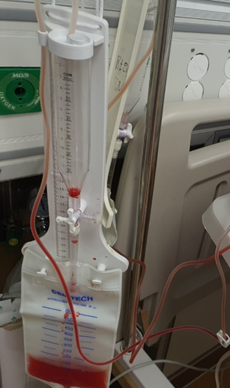 수두증(hydrocephalus), EVD(extraventricular drainage) : 네이버 블로그