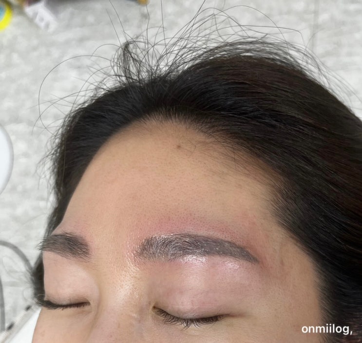 인천 미작뷰티 구월동 붉은잔흔 눈썹문신제거 1회차 후기 네이버 블로그