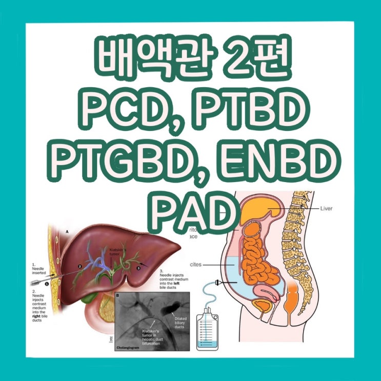 [응급실 간호] 배액관 2편. PCD, PTBD, PTGBD, ENBD, PAD 배액관 총정리 : 네이버 블로그