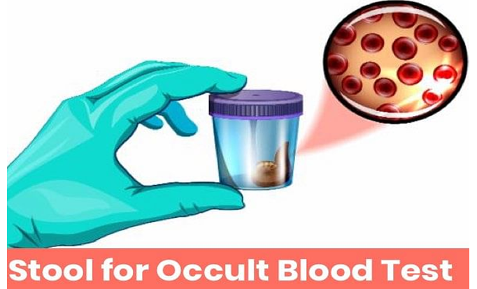5-2. Stool sample, Occult blood test : 네이버 블로그