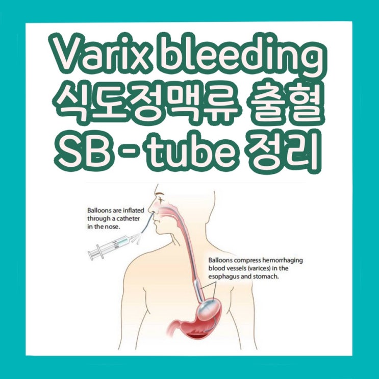 [응급실간호] GI Varix bleeding, 식도정맥류 출혈, SB - tube 총정리 : 네이버 블로그