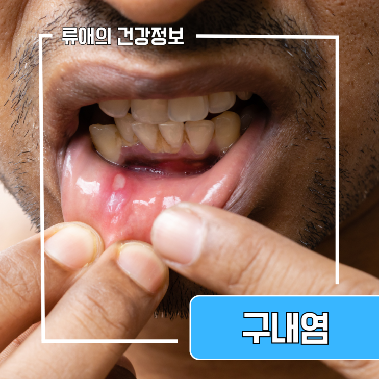 목 구내염빨리낫는법 구내염 원인 연고 약 정리 네이버 블로그