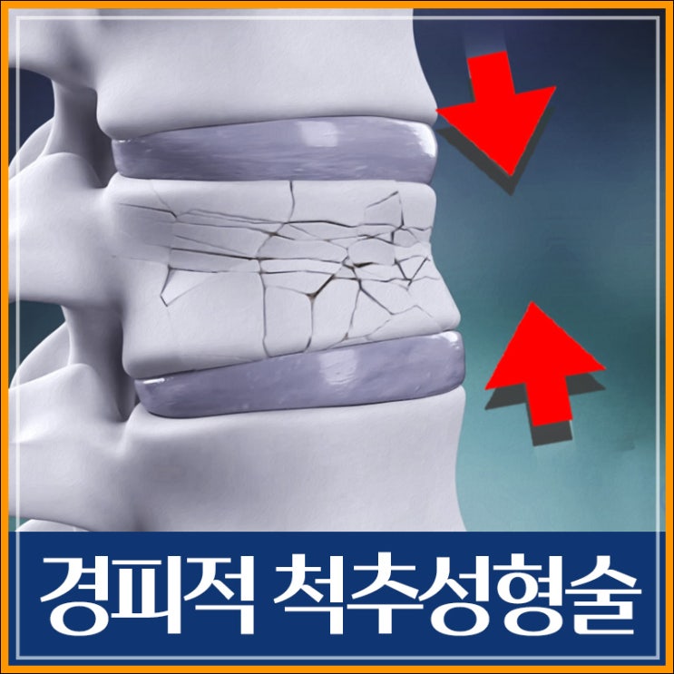 경피적 척추성형술 압박골절로 무너진 허리를 바로 세우는 방법 네이버 블로그