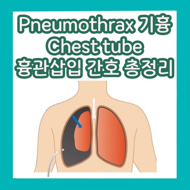 [응급실 간호] Pneumothorax 기흉, Thoracostomy(흉관삽입술), Chest tube 간호 총정리 : 네이버 블로그