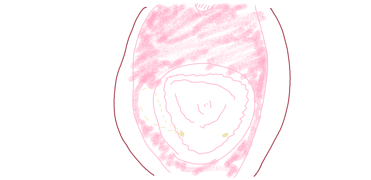 vulva mass, bartholin's cyst (bartholinitis) 바르톨린샘염, endometrial polyp ...