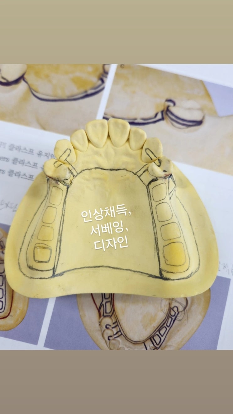 [🦷국소의치학 실습]상하악 캐스트에 서베잉, 국소의치 디자인(class 2 mod 1/class 1/I bar 클래스프/레스트 ...