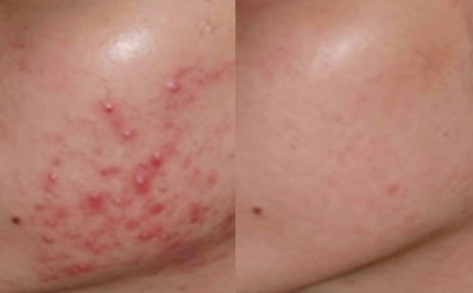 마데카솔겔 수분크림 가격 사용법 여드름 없앤 꿀팁 네이버 블로그