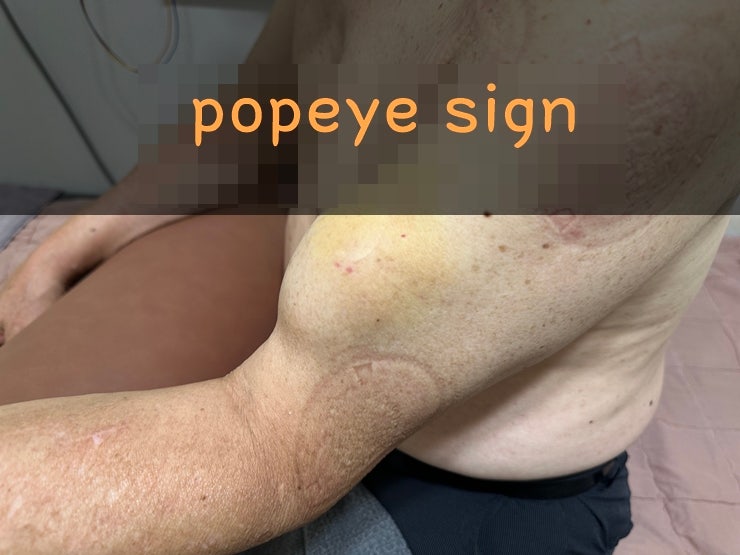 상완 이두근 장두 파열, 뽀빠이 사인(popeye sign) : 네이버 블로그