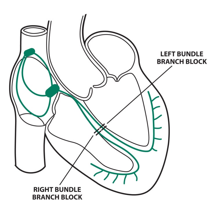 Bundle Branch Block, 우각차단(RBBB) & 좌각차단(LBBB) : 네이버 블로그