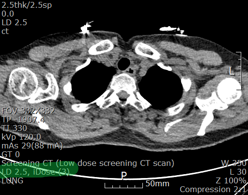 흉부 시티 검사, 간단히 알아봐요! (Chest CT, PACS) : 네이버 블로그