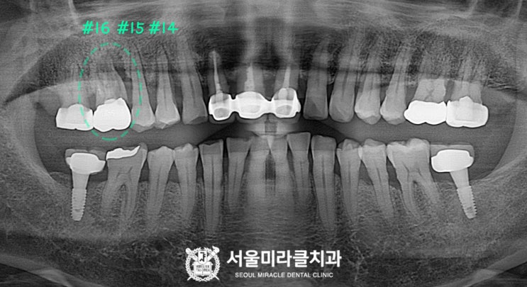 치아 뿌리 파절과 염증으로 인한 통증 산본 치과 에서 수면 치료로 진행한 발치 즉시 임플란트 식립 과정 네이버 블로그