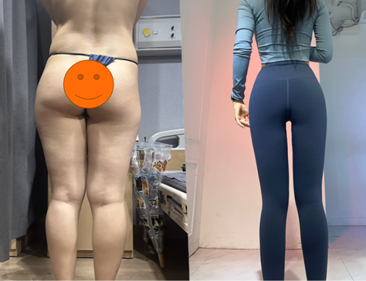 숫자병원 허벅지 지방흡입 후기 (365mc 가격 정보공유) : 네이버 블로그