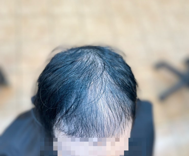 여자 심한전체탈모 히든탈모커버성형펌 계산전계산후 부산사상 르네시떼6층 미용실 네이버 블로그