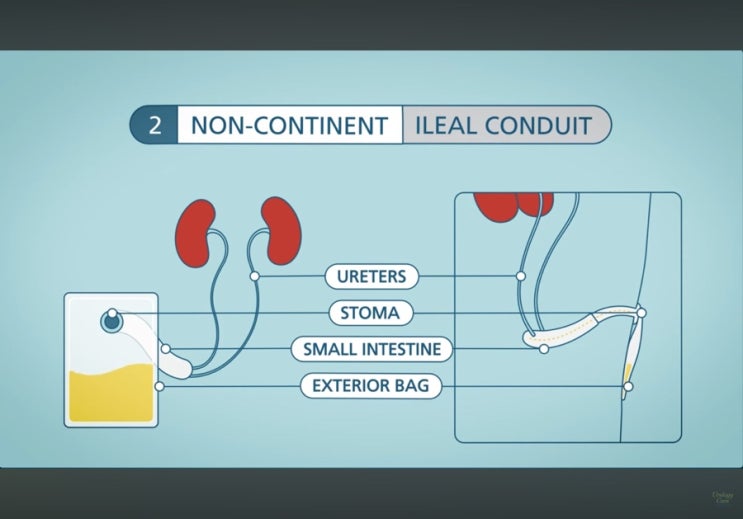 Urostomy (Ileal conduit) vs Cystostomy vs nephrostomy 공부하기 : 네이버 블로그