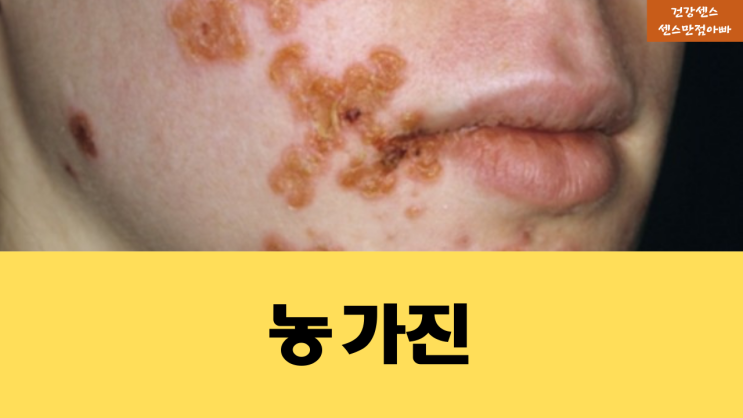 전염성 있는 아기 농가진 원인 증상 격리 치료 예방 정확히 알기 네이버 블로그