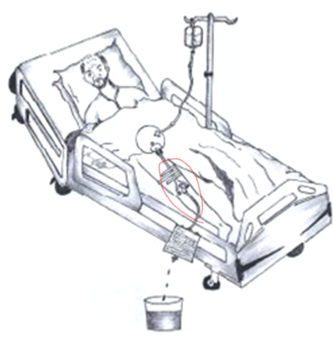 전립선 수술 후 혈뇨 처치: Foley traction : 네이버 블로그