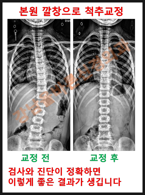 어린이척추측만증 원인과 치료를 위한 척추측만증보조기에 대해서 네이버 블로그