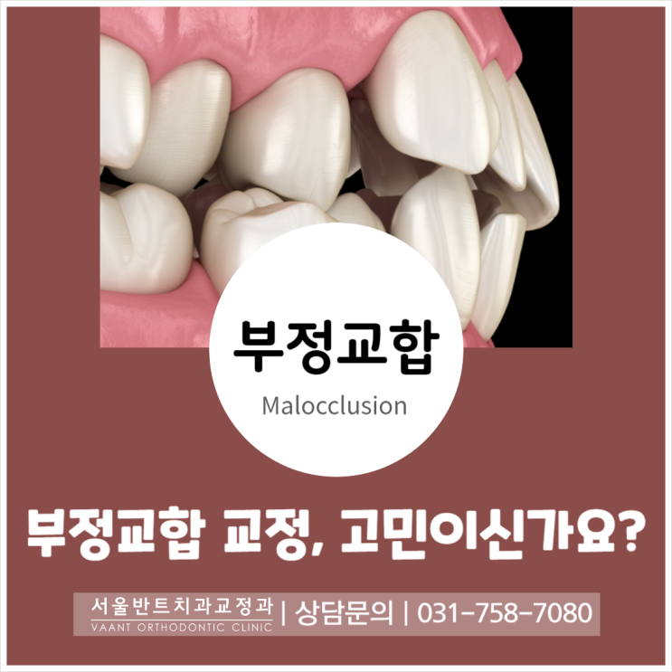 부정교합 교정은 위례 서울반트치과교정과에서 시작하세요 네이버 블로그