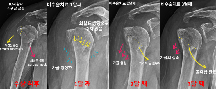 87세 환자의 근위 상완골 골절 Proximal Humerus Fracture 비수술 치료로도 좋은 결과를 얻을 수 있습니다