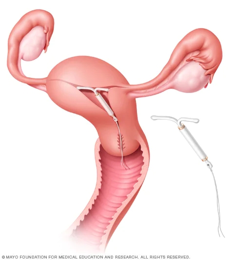 미레나 시술 효과와 부작용 강서구 산부인과 효과와 유지기간 출혈 및 호르몬 부작용 네이버 블로그