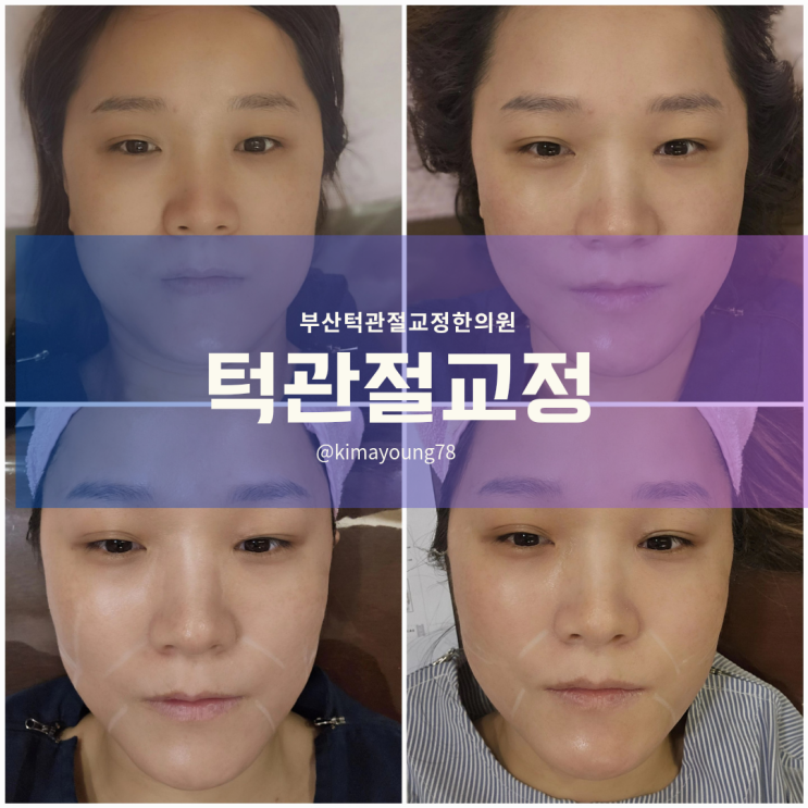 서면턱관절교정 한의원 드디어 8회차 완료한 내 후기 네이버 블로그