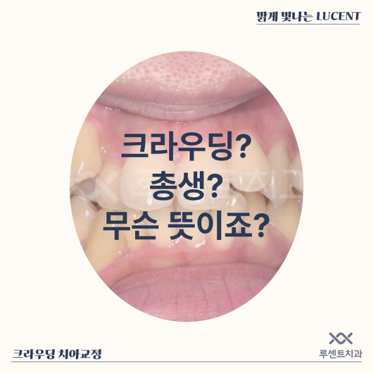 얼굴이 작으면 생기는 부정교합이 있다 크라우딩 치아교정 네이버 블로그