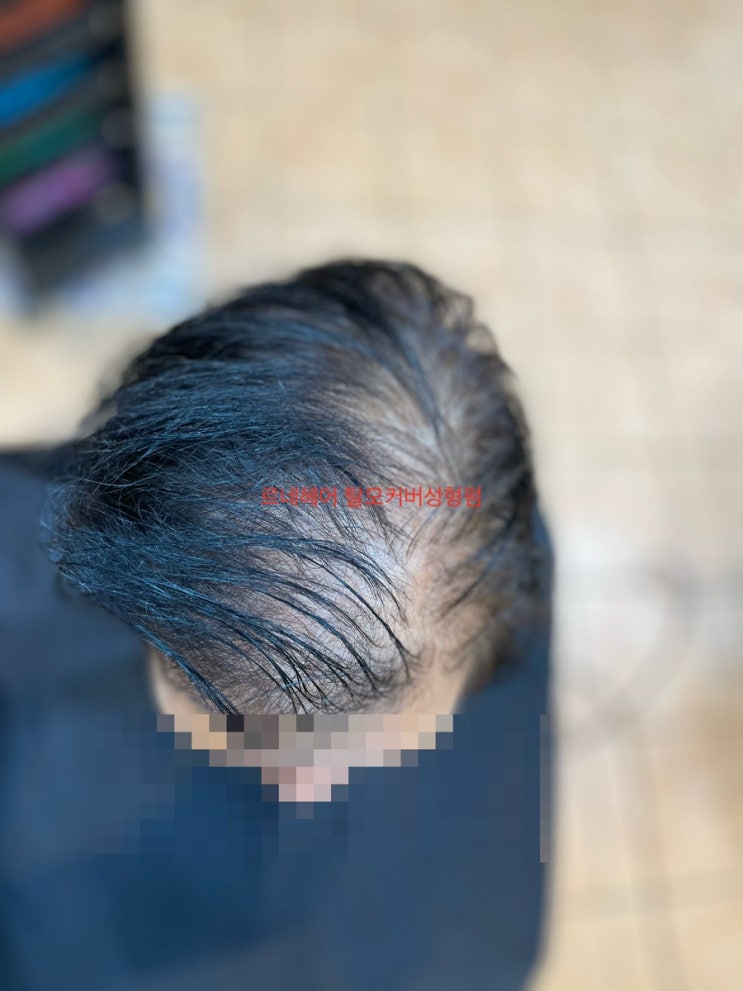심한여자탈모펌시술후 부산 사상탈모클리닉전문 르네시떼미용실 감전모라덕천화명명지대저대동용원녹산김해울산양산남해진주창원밀양하동경주